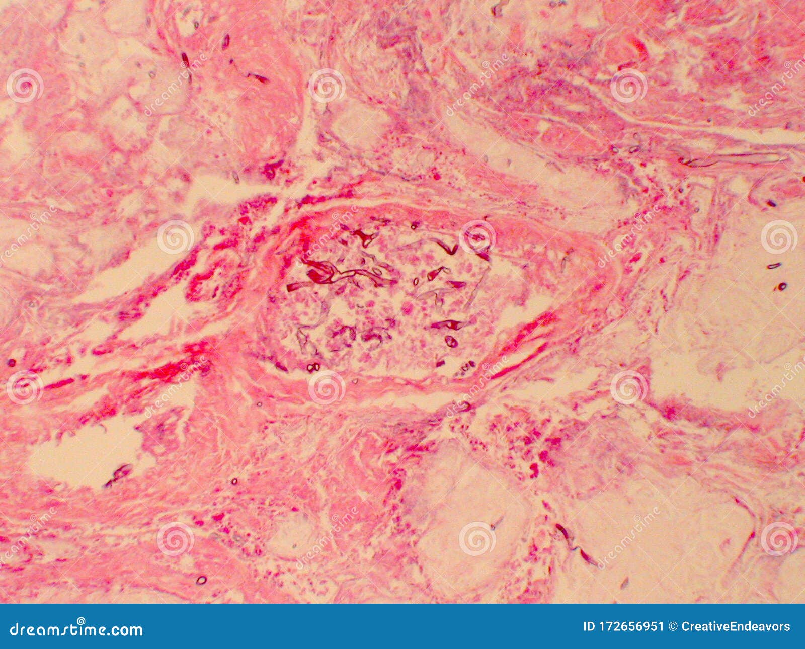 Apophysomyces Hyphae Cluster in Tissue Biopsy Specimen Stock Image ...