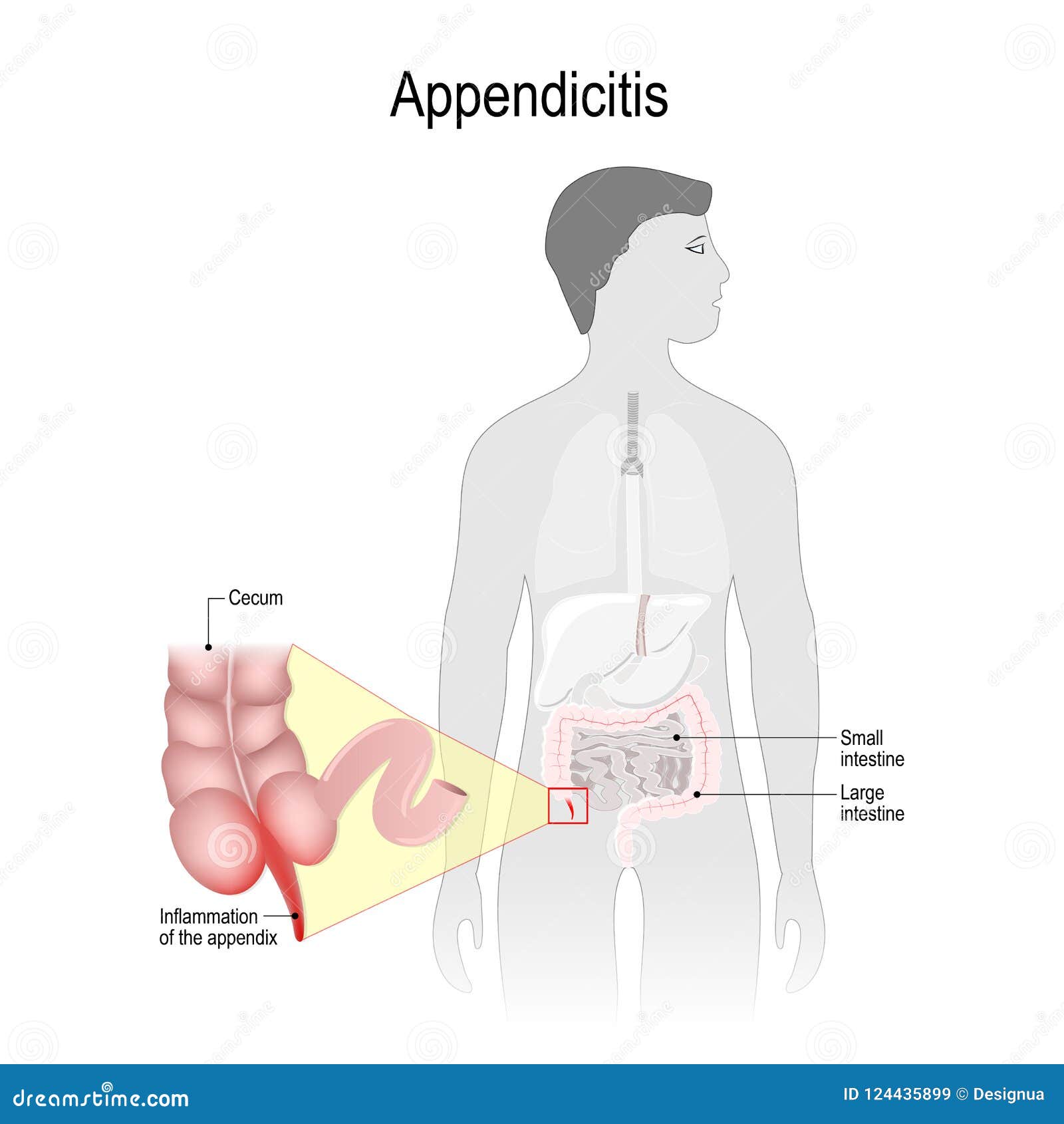 Appendicite Stock Illustrations, Vecteurs, & Clipart – (214 Stock ...