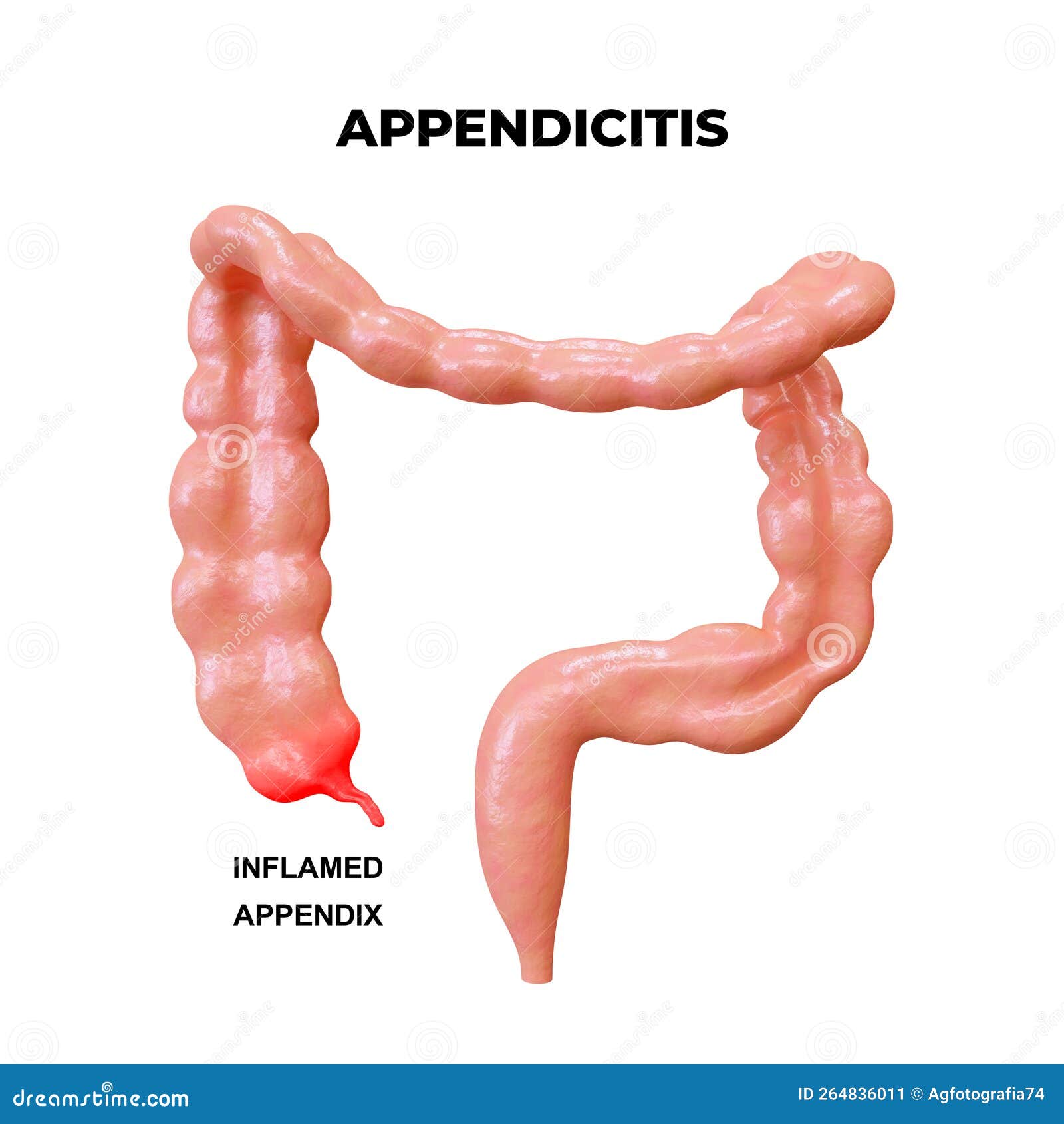 Appendicitis Consists Of Inflammation And Infection Of The Appendix A