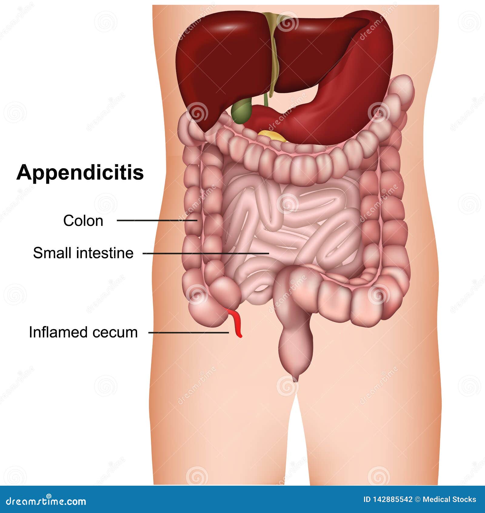 3d Illustration Of Appendicitis Concept Human Intestine Anatomy