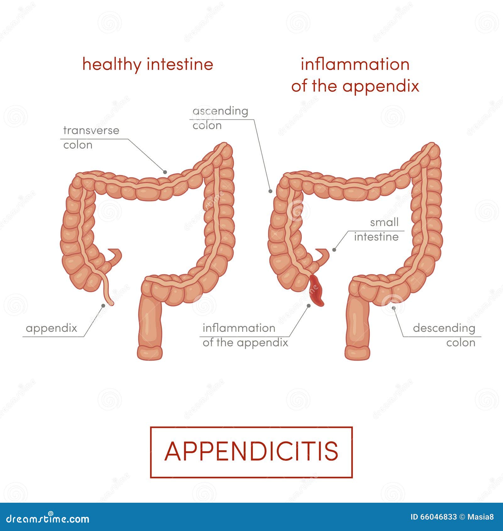 3d Illustration Of Appendicitis Concept Human Intestine Anatomy