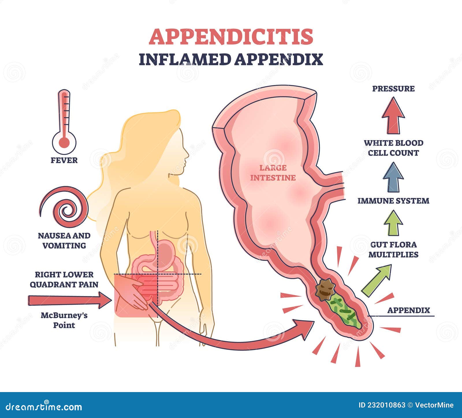 Appendicitis Inflamed Appendix Labeled Chart Cartoon Vector