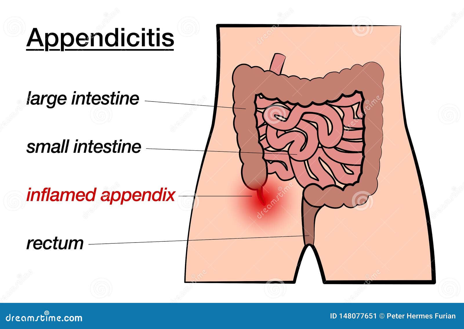 Appendicitis Inflamed Appendix Labeled Chart Stock Vector
