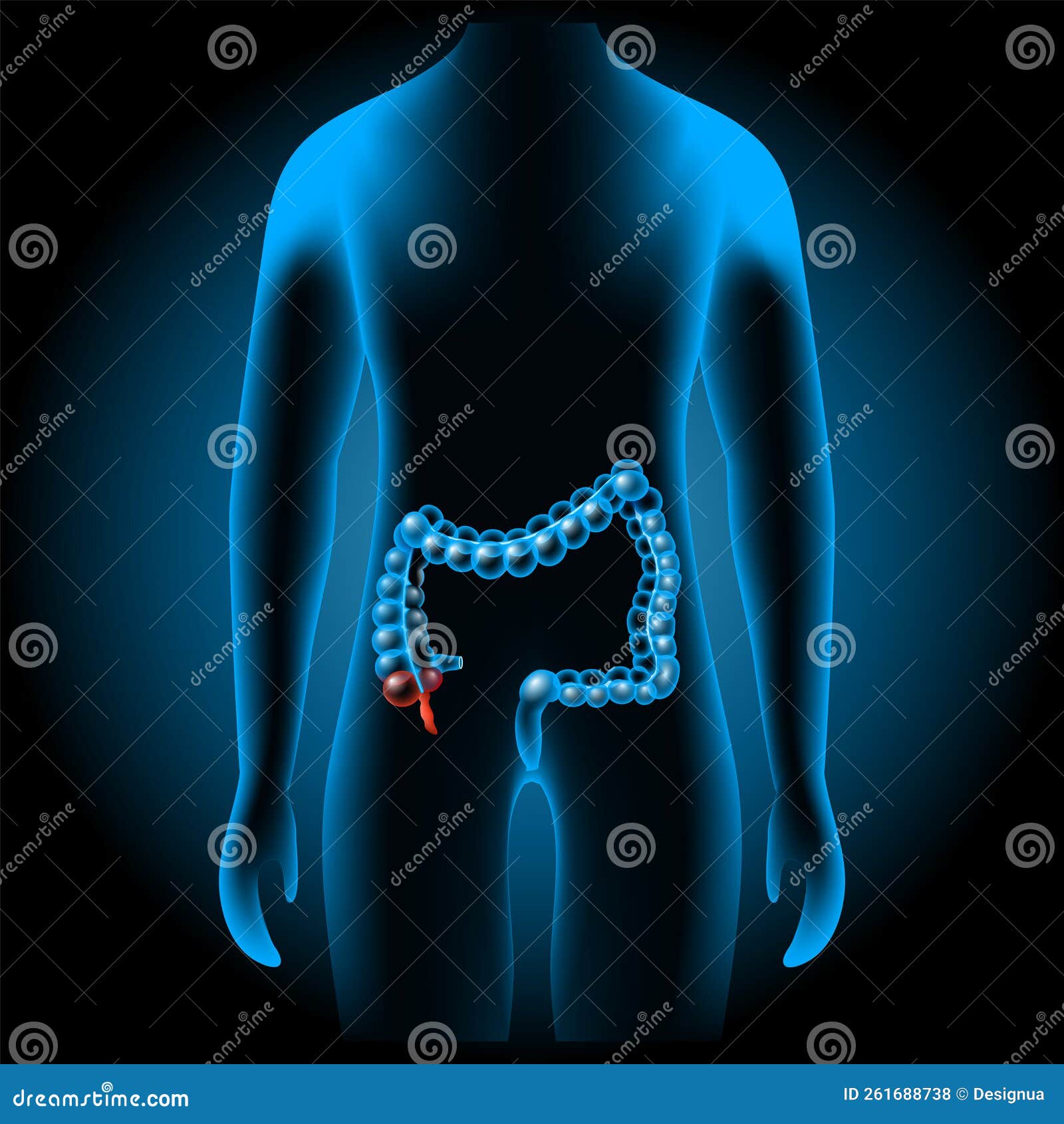 Appendicitis. Inflammation of the Appendix Stock Vector - Illustration ...