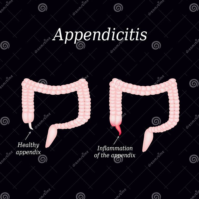 Appendicitis. Inflammation of the Appendix. Colon Stock Vector ...