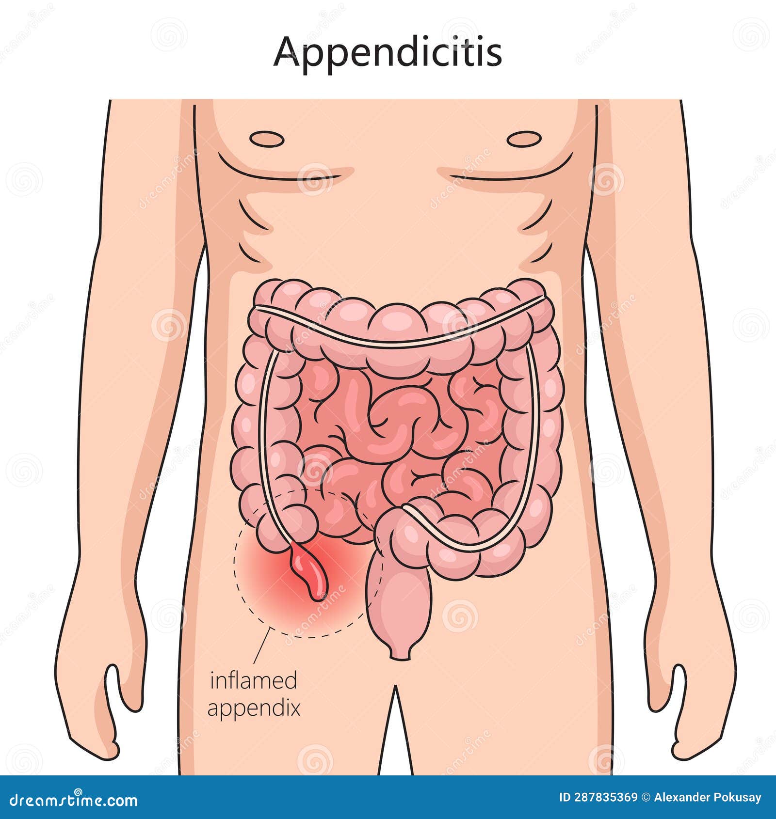 Appendicitis Inflammation Of Appendix Medical Stock Illustration