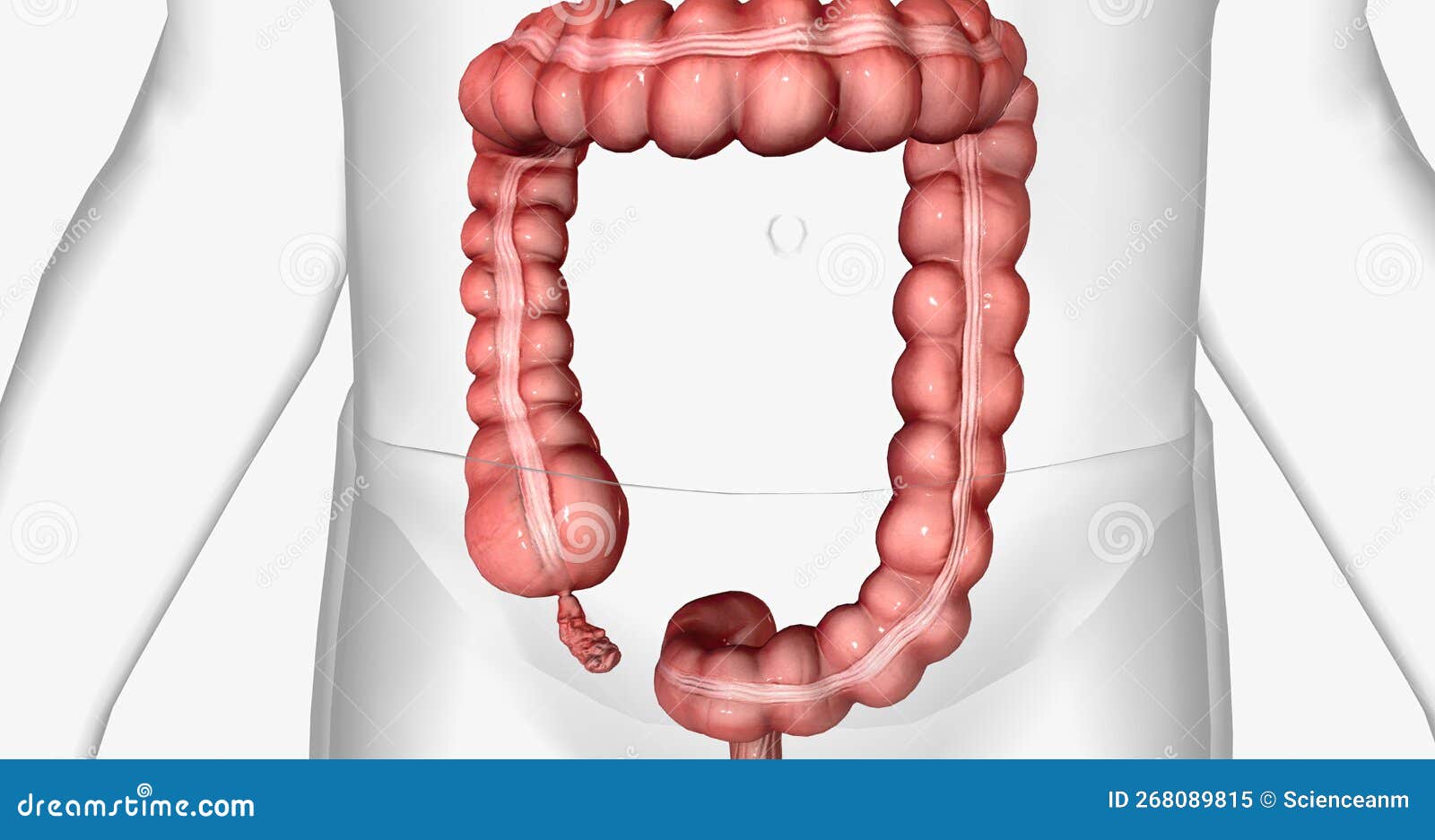 Appendicitis Is The Inflammation Of The Appendix A Thin Tube Like
