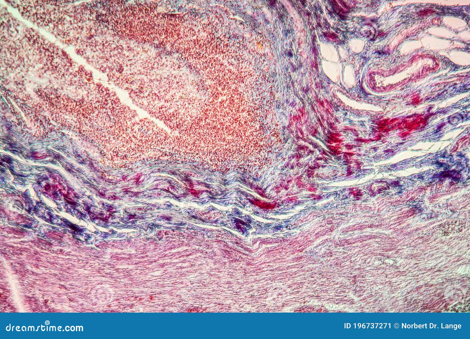 Inflammation Of Appendicitis, Stomach Ulcer, Bloating, Man With ...