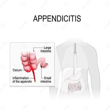 Appendicitis. Location in the Human Digestive System Stock Vector ...