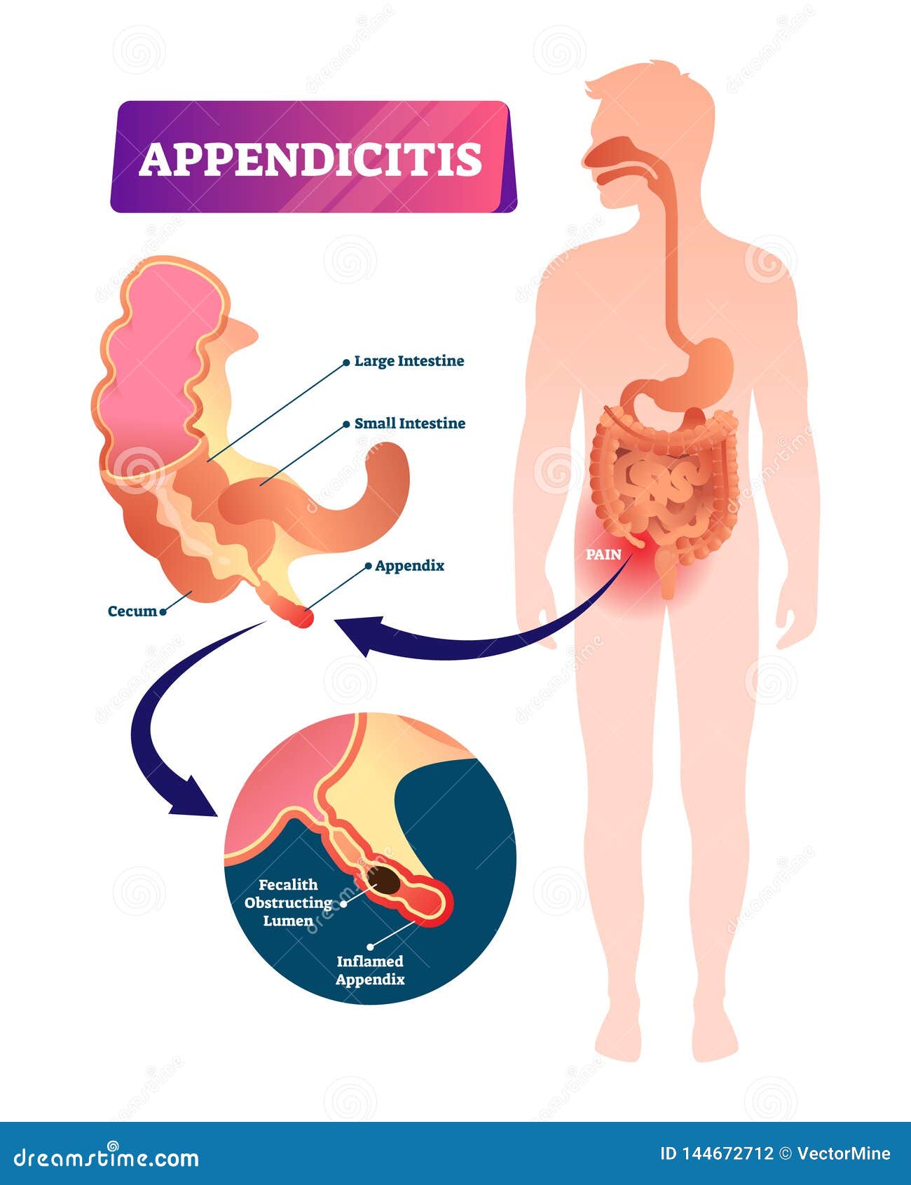 3d Illustration Of Appendicitis Concept Human Intestine Anatomy