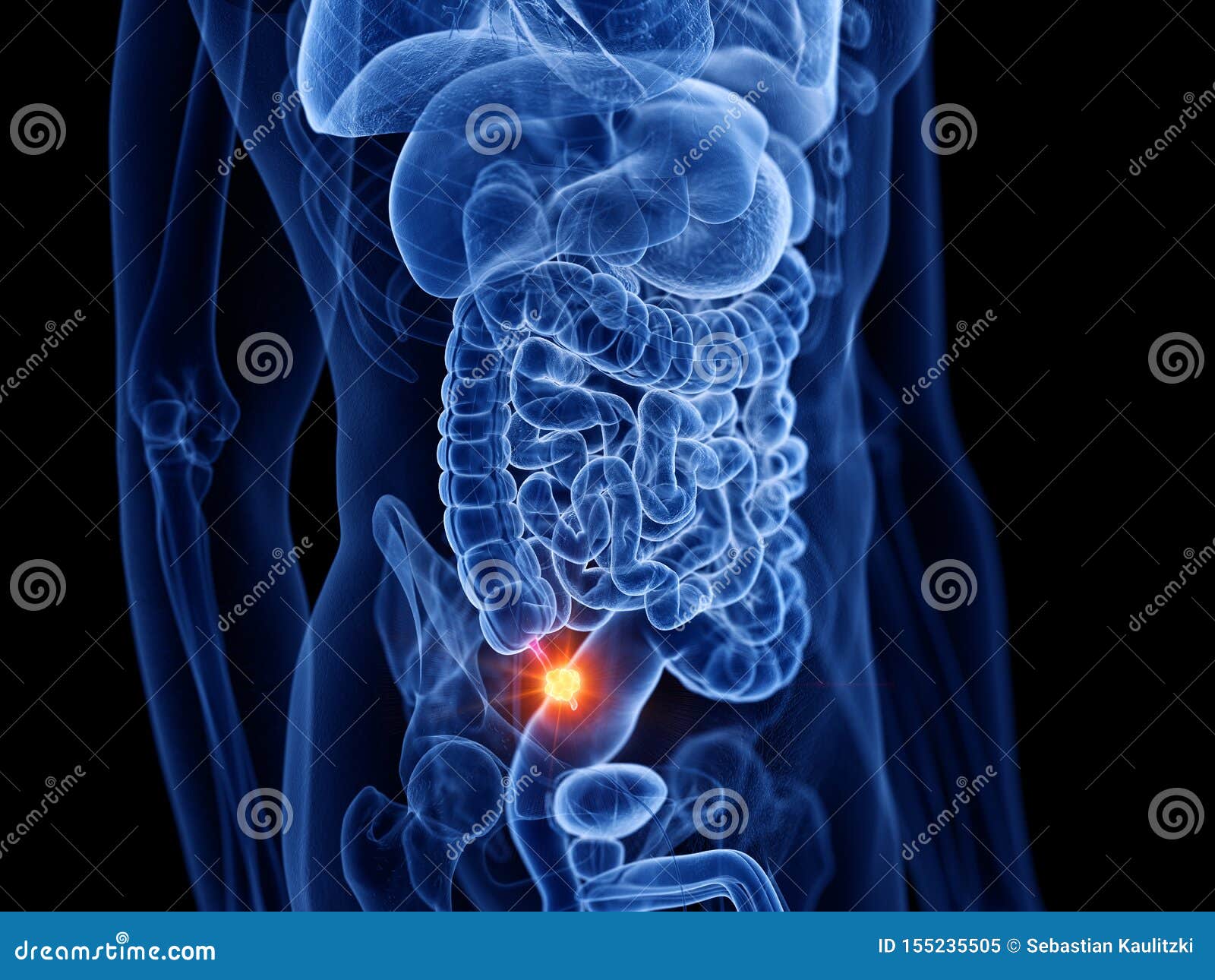 Appendix Cancer Awareness Ribbon Vector Illustration Isolated On White ...