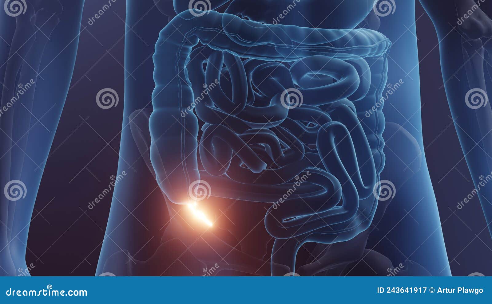 Appendicitis Human Silhouette With A Colon Small Intestine And An