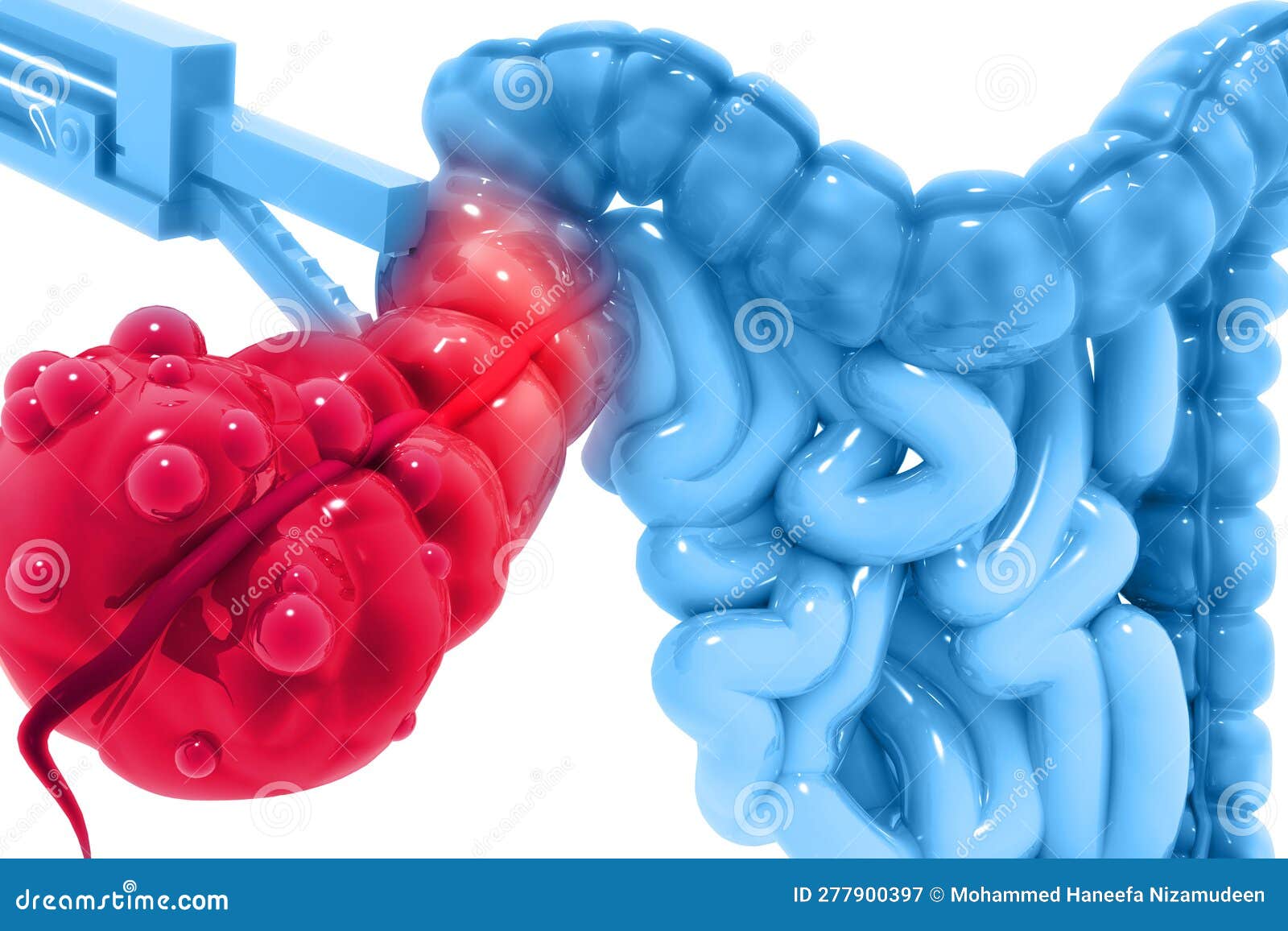Appendix surgery stock illustration. Illustration of equipment - 277900397