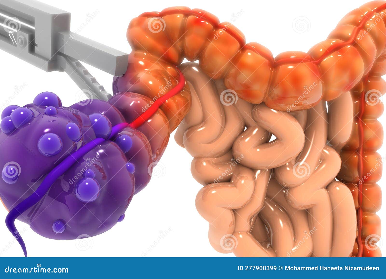 Appendix surgery. stock illustration. Illustration of health - 277900399