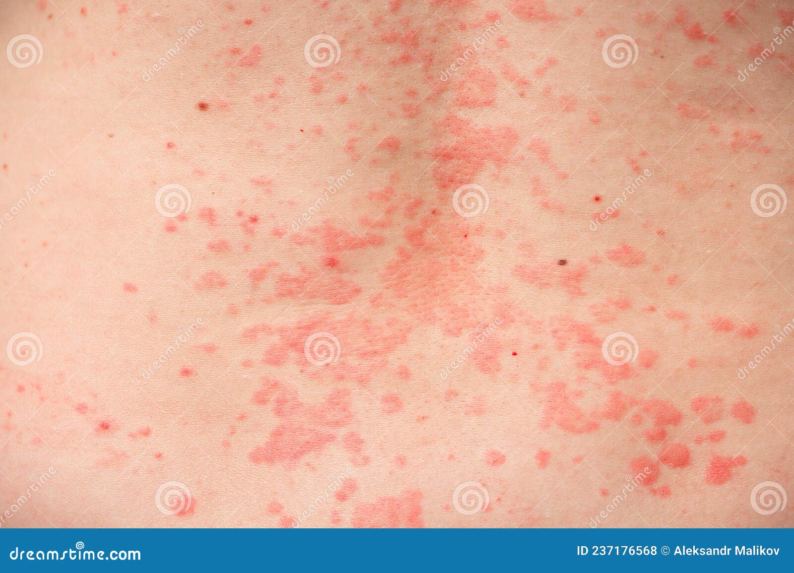 An Area of the Body Covered with an Allergic Rash, Very Close-up Stock ...