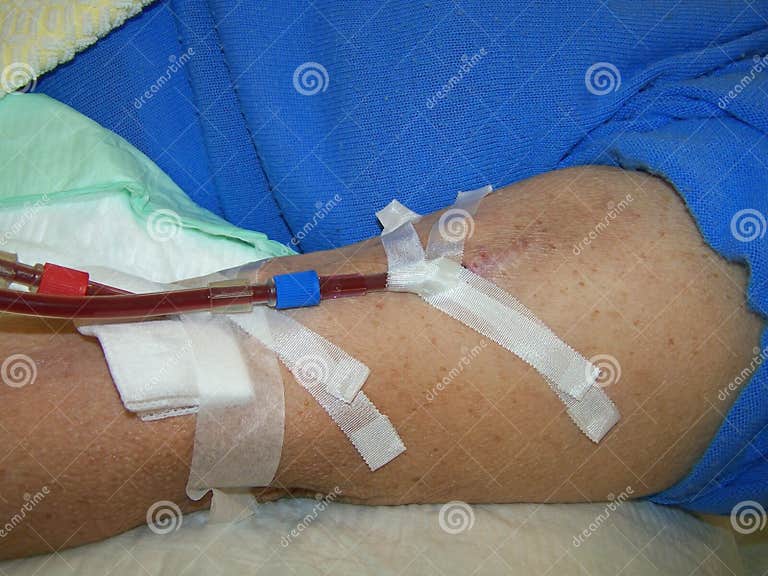 Arm with dialysis shunt stock photo. Image of renal, kidney - 383570