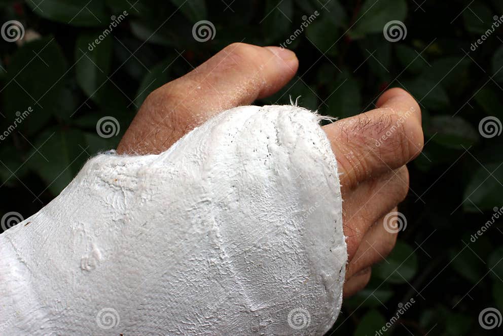 Arm im Gips stockbild. Bild von rest, bruch, pflaster - 34762179