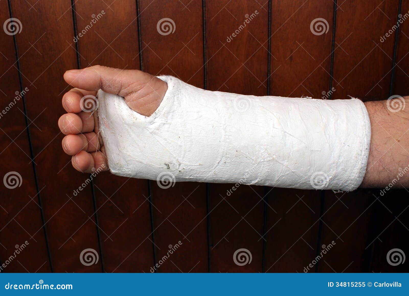 Arm im Gips stockbild. Bild von mann, daumen, finger - 34815255