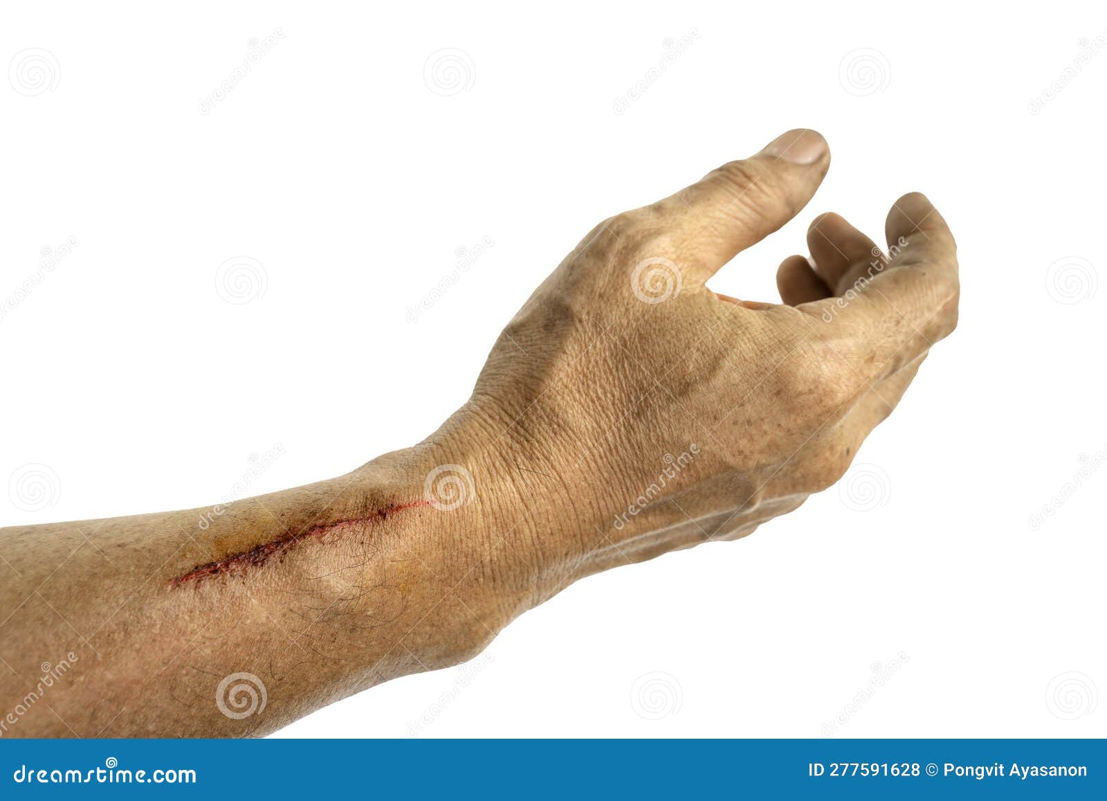 Arm Injuries from Work Accidents on a White Background Stock Photo ...