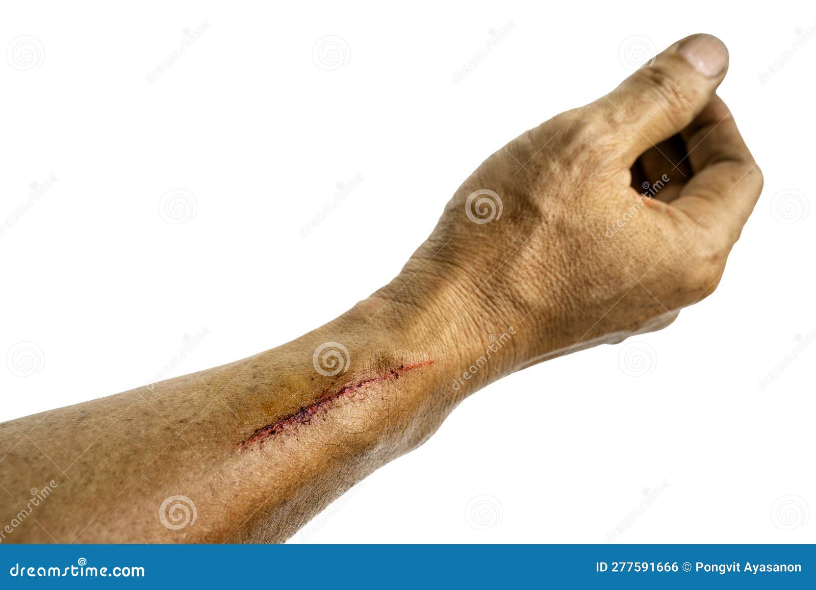Arm Injuries from Work Accidents on a White Background Stock Photo ...