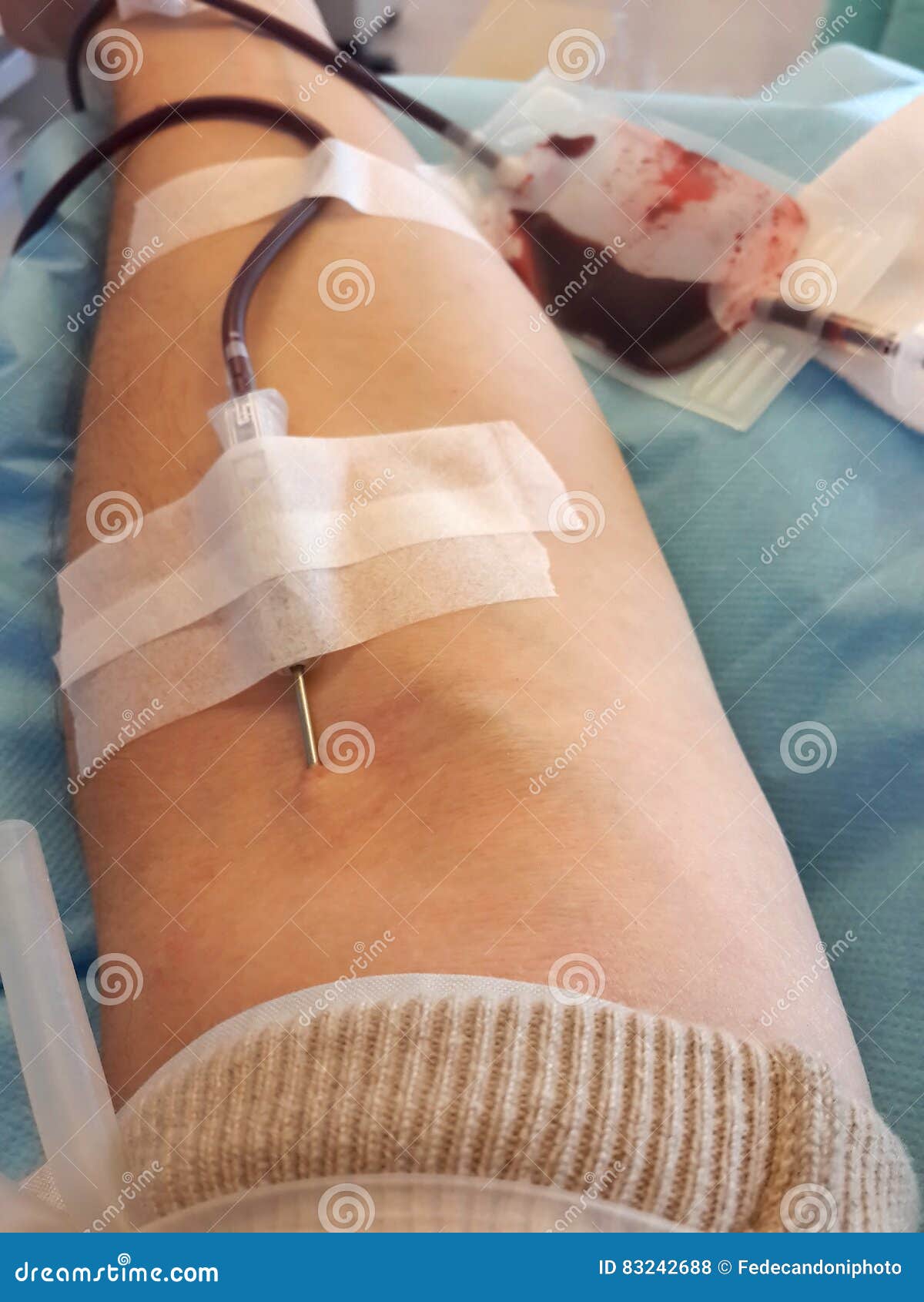 Arm with Needle during Blood Transfusion Stock Photo - Image of ...