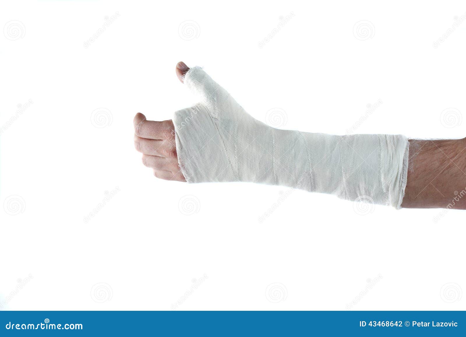 Arm in Plaster Cast stock photo. Image of human, injury - 43468642