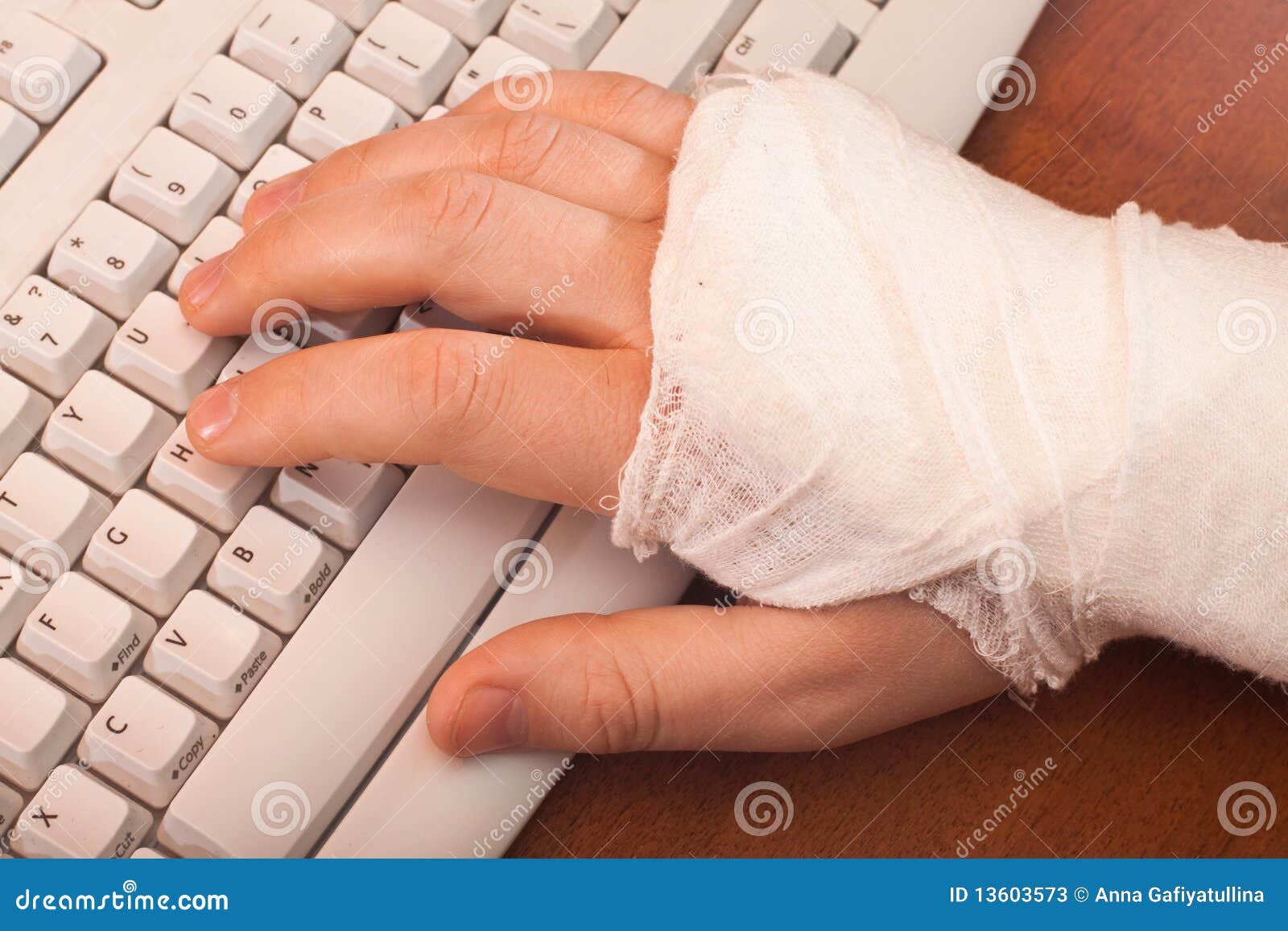 Arm in Plaster on the Keyboard Stock Image - Image of bandage, human ...