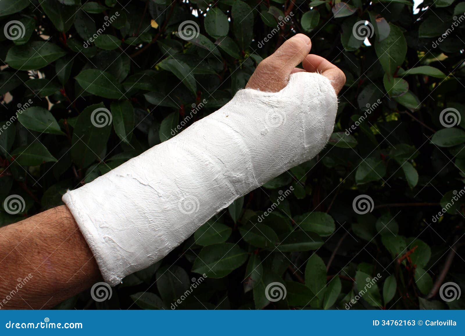 Arm in plaster stock image. Image of broken, plaster - 34762163