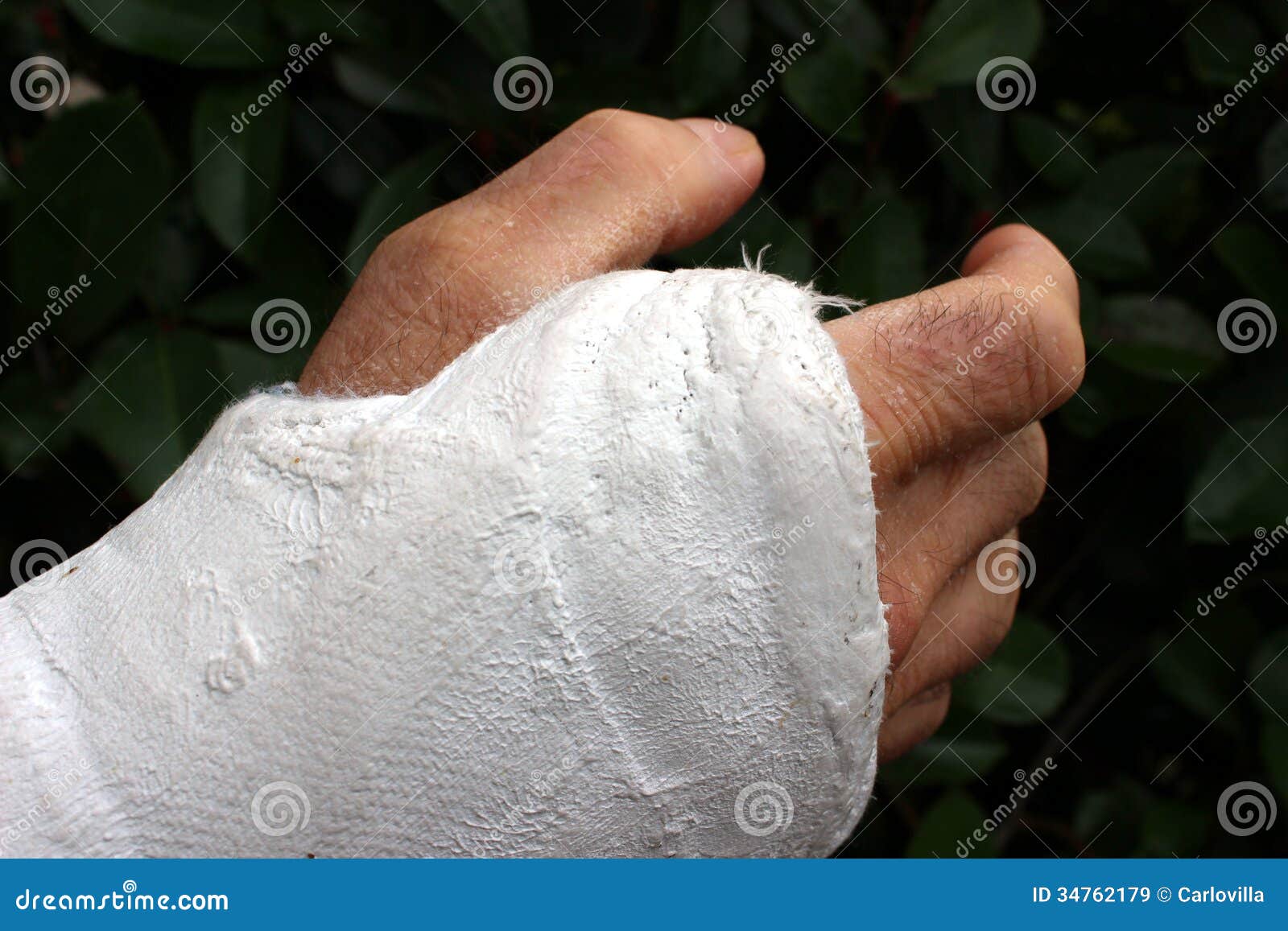 Arm in plaster stock image. Image of sanity, break, rest - 34762179