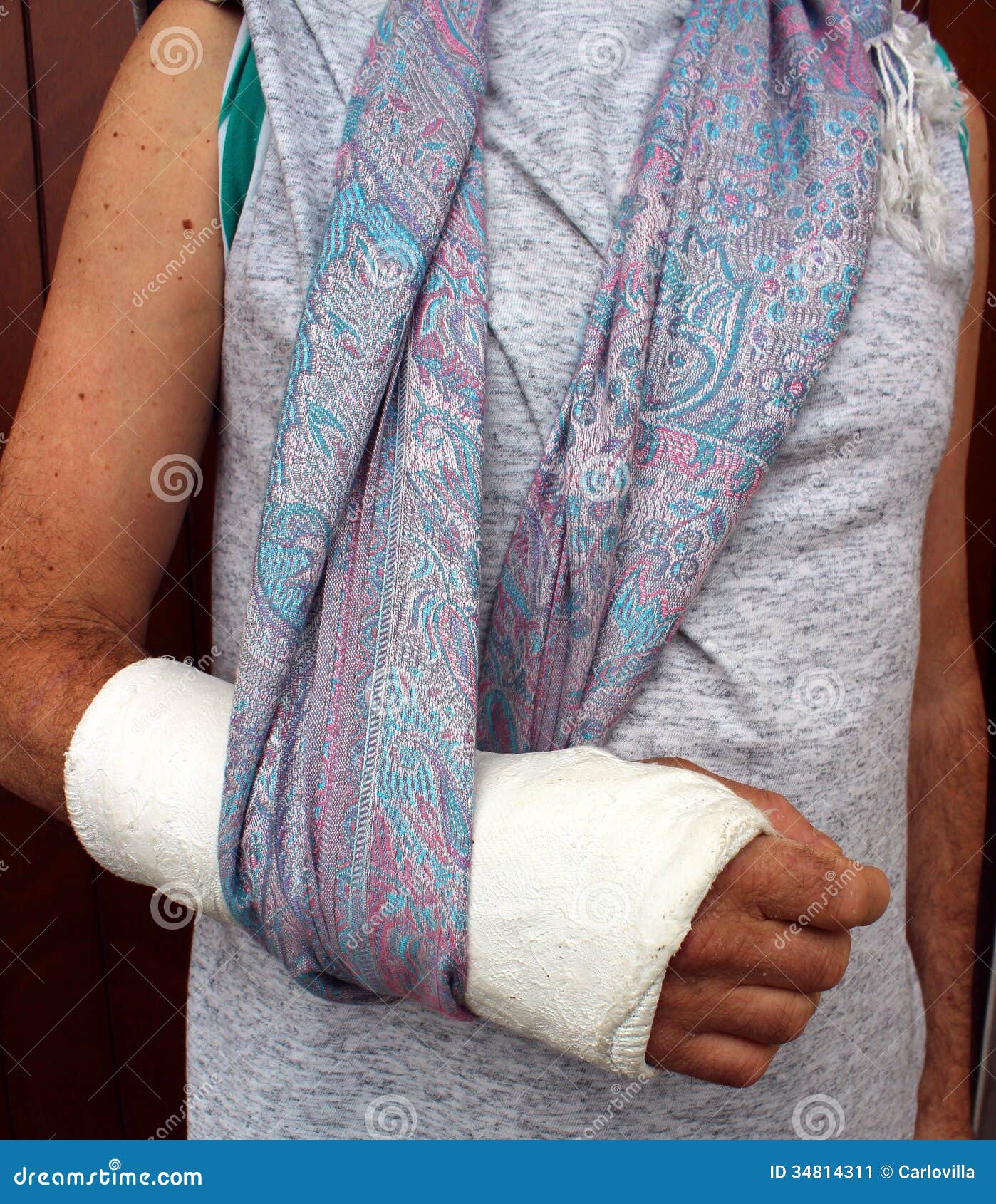Arm in plaster stock image. Image of disease, white, broken - 34814311