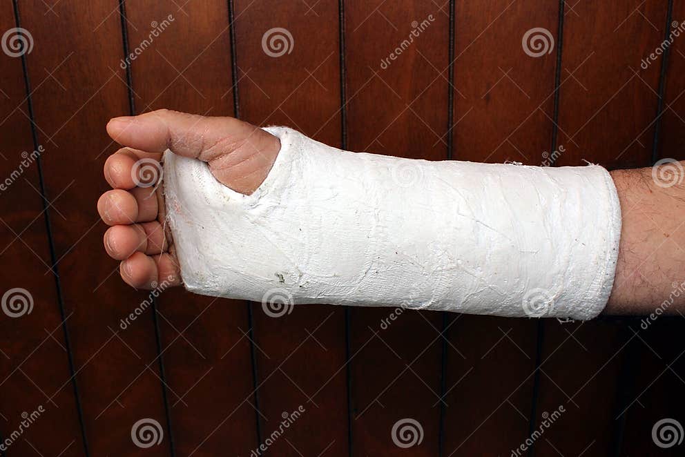 Arm in plaster stock image. Image of material, white - 34815255