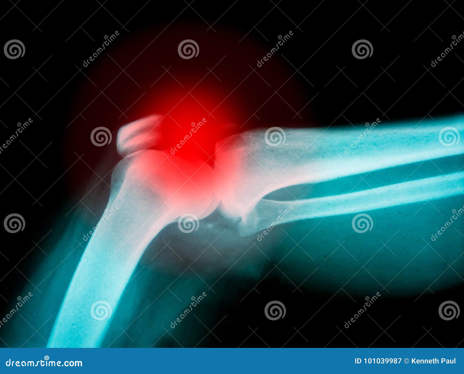 Arm X-ray with Highlight on Broken Bone Stock Image - Image of elbow ...