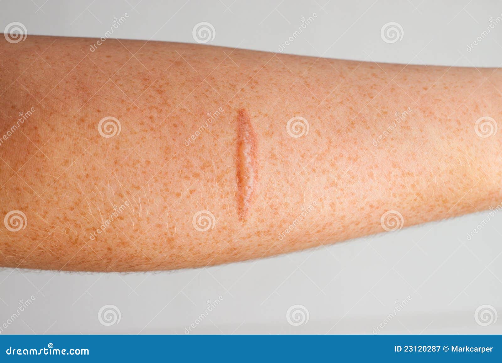 Arm Scar stock image. Image of freckled, oven, melt, bubble - 23120287