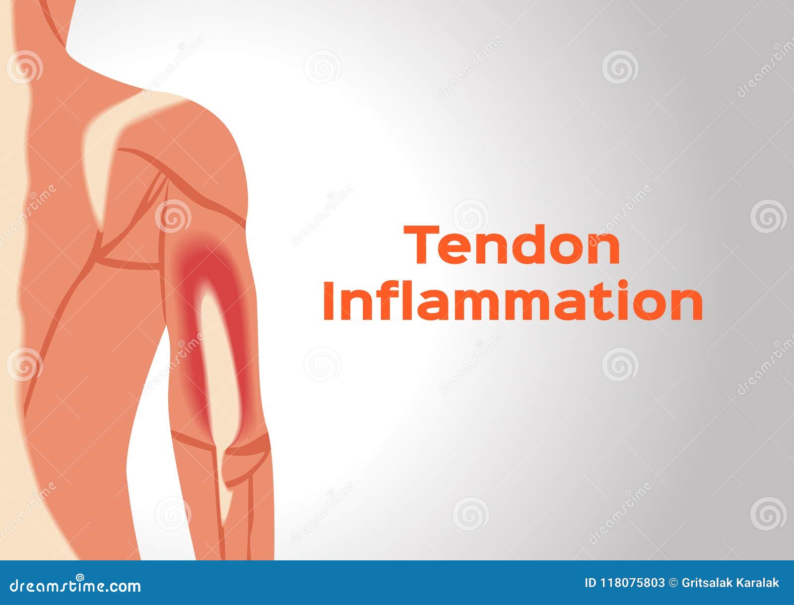 Arm Tendon Inflammation Cartoon Vector | CartoonDealer.com #118075803