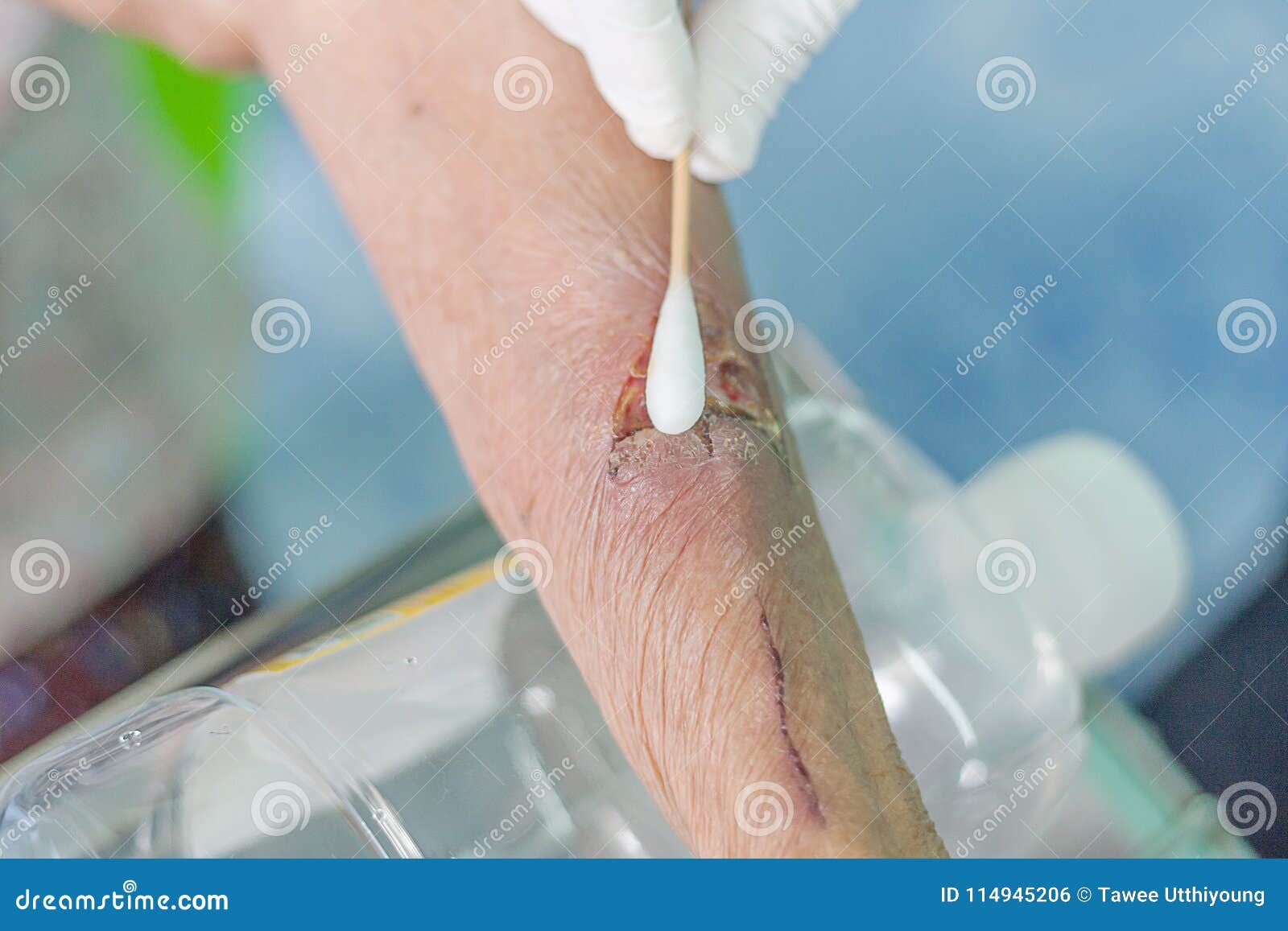 Arm wound closeup stock photo. Image of patient, injury - 114945206
