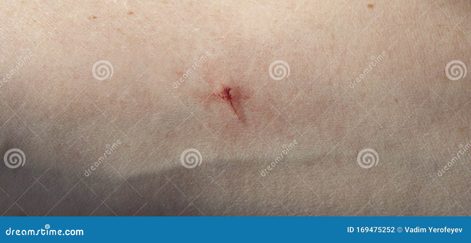 Hand with a Cut on the Hand Stock Photo - Image of injure, scar: 169475252