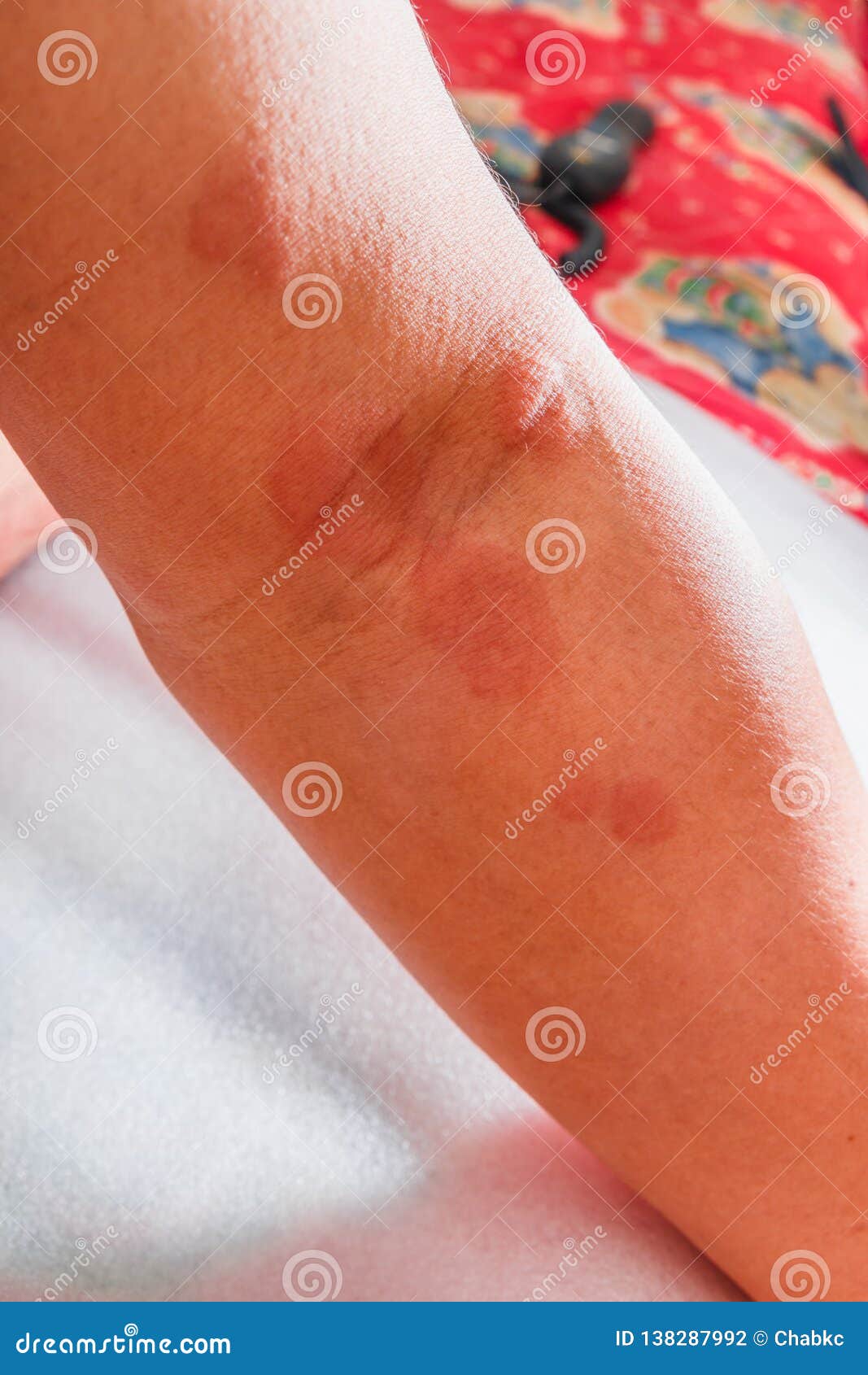 Around Arm of Man with Dermatitis Problem Stock Photo - Image of itchy ...