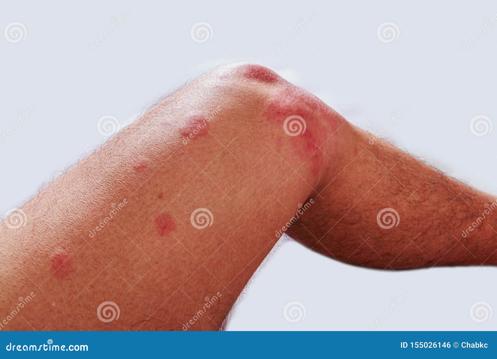 Around Legs of Men with Dermatitis Problem of Rash ,allergy Rash Stock ...