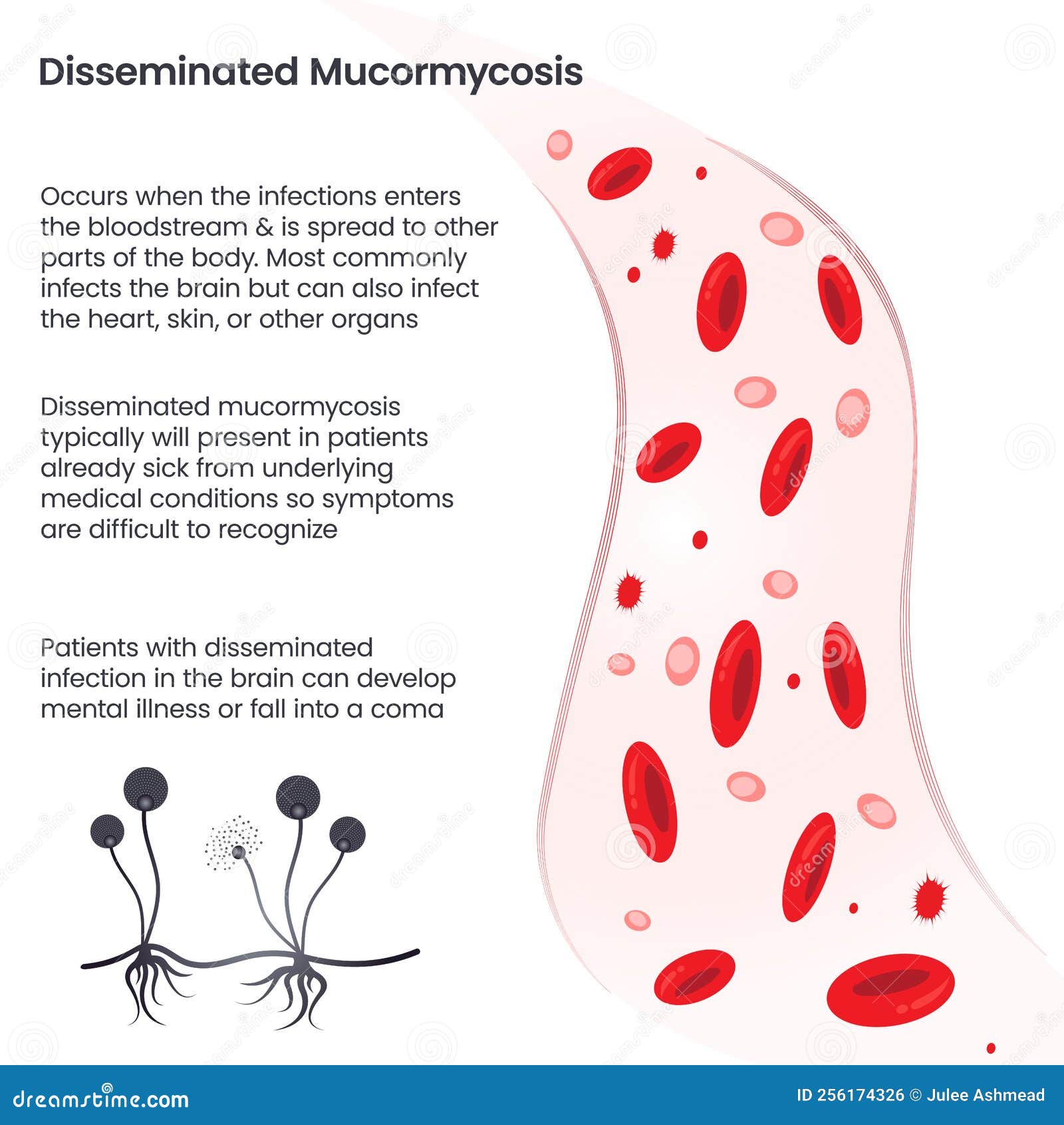 Disseminated Mucormycosis Vector Illustration Informational Graphic ...