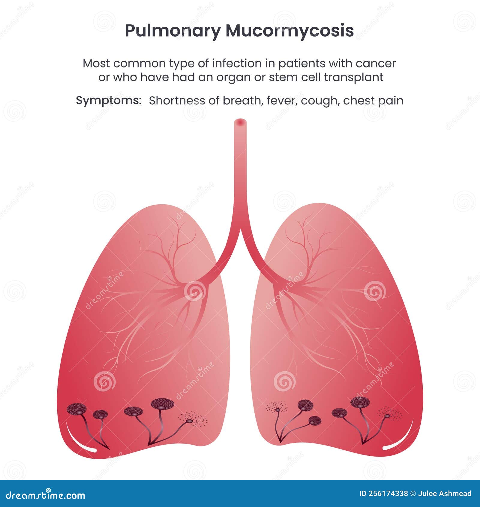 Pulmonary Mucormycosis Vector Illustration Informational Graphic Stock ...