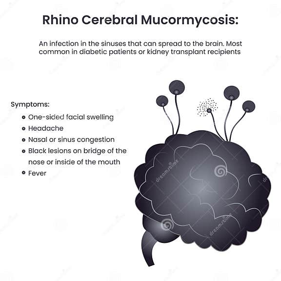Rhinocerebral Mucormycosis Brain Black Fungus Infection Vector ...