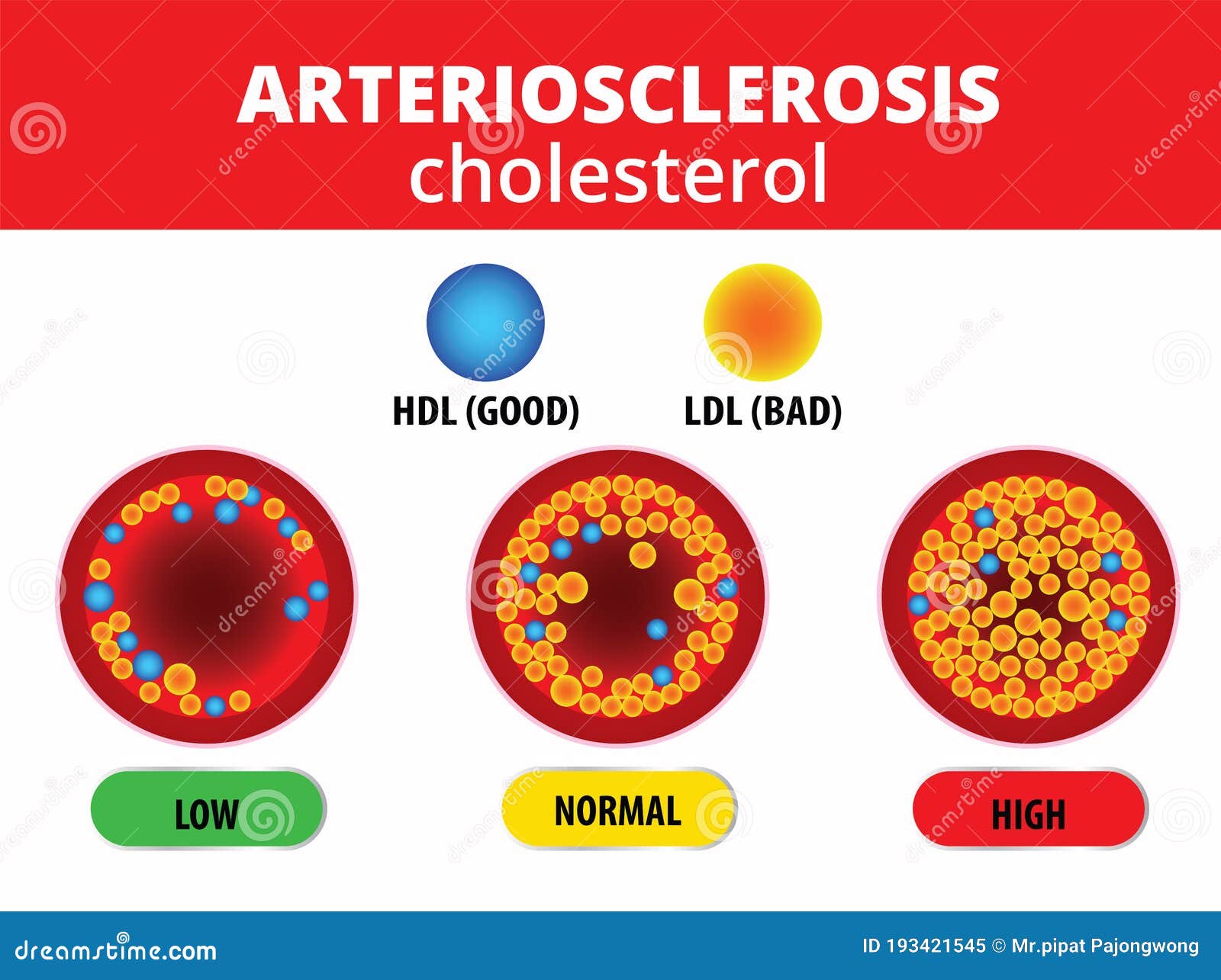 Arteriosclerosis , Cholesterol in Artery. Stock Vector - Illustration ...