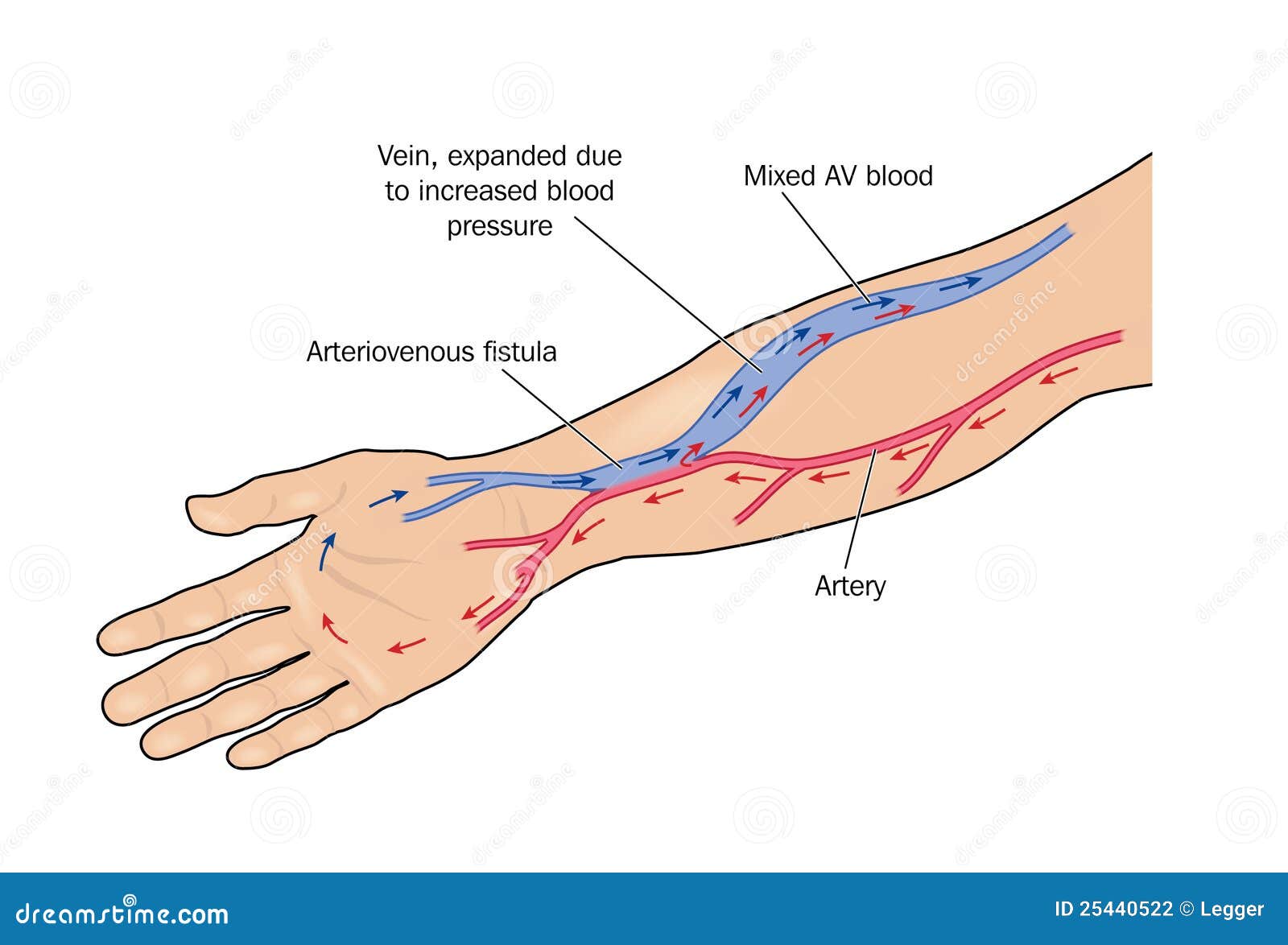 Arteriovenous fistel stock illustratie. Illustration of mislukking ...