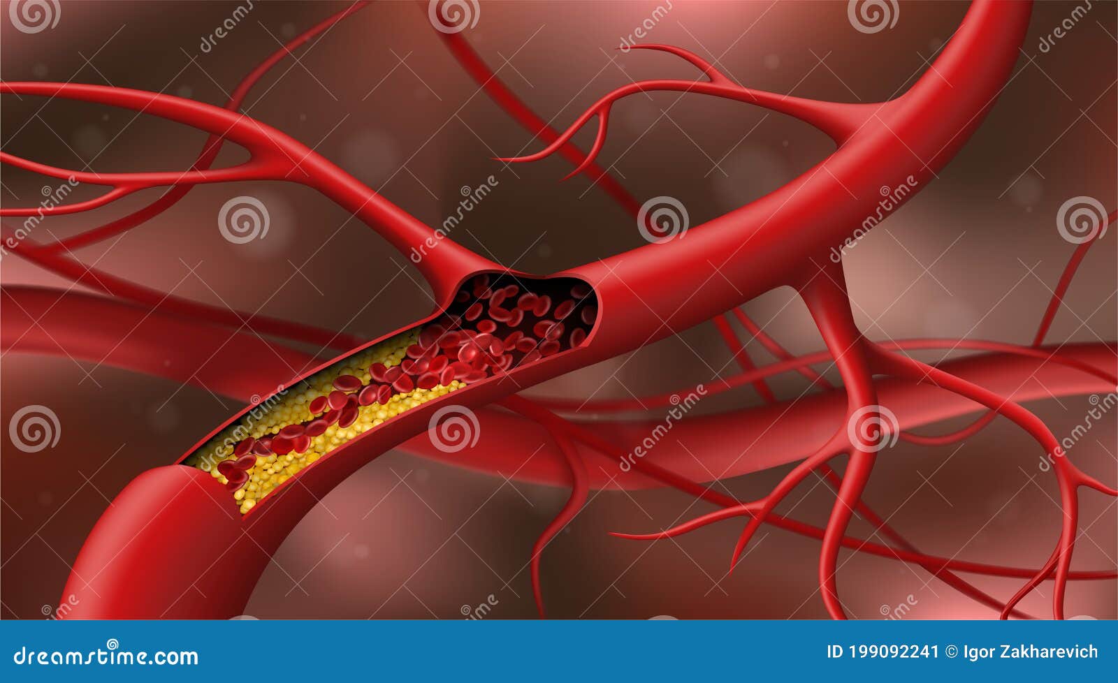 Artery Blocked With Cholesterol Illustration Blood Pressure Design, The ...