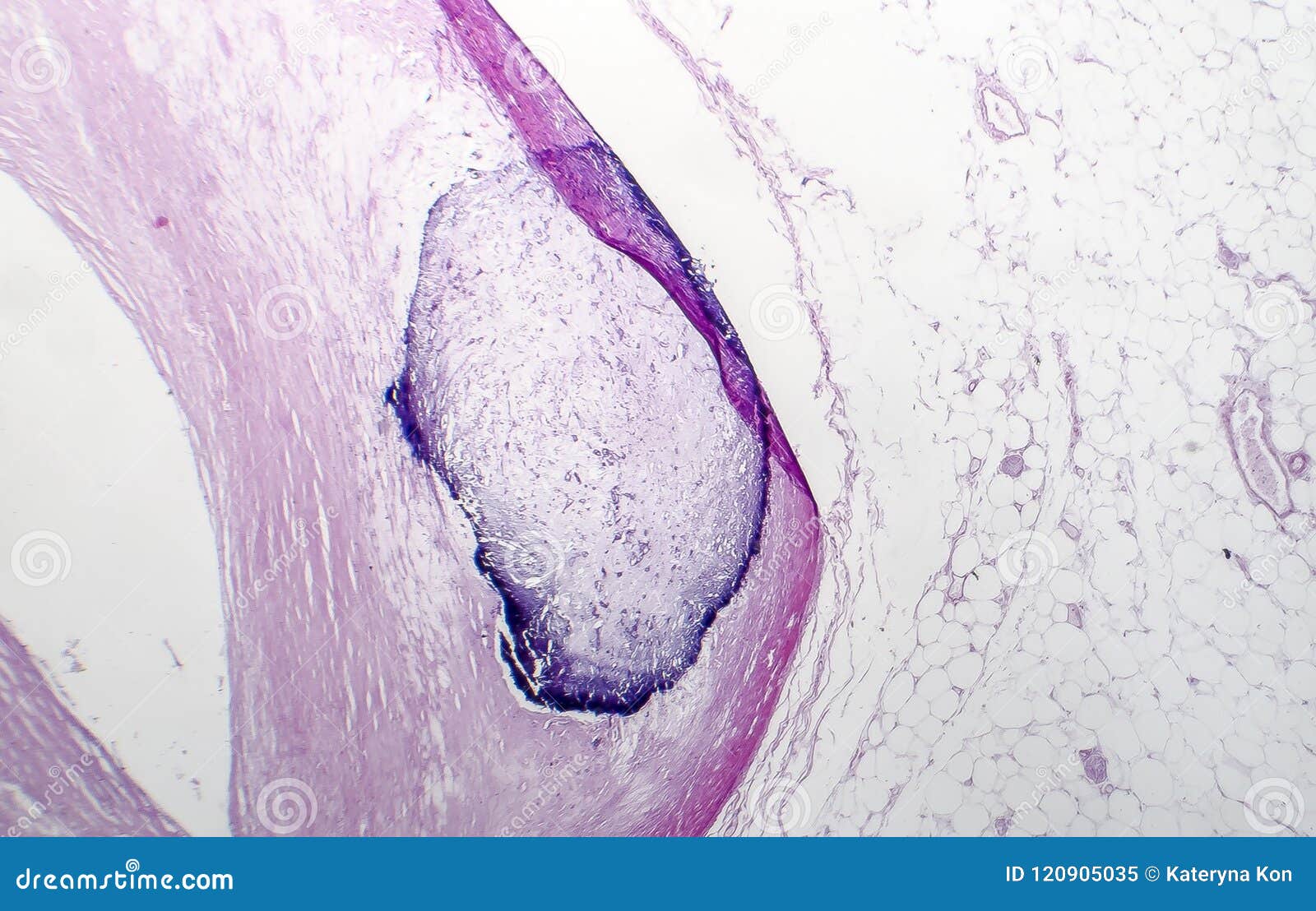 Artery Calcification Histopathology Stock Image - Image of micrograph ...