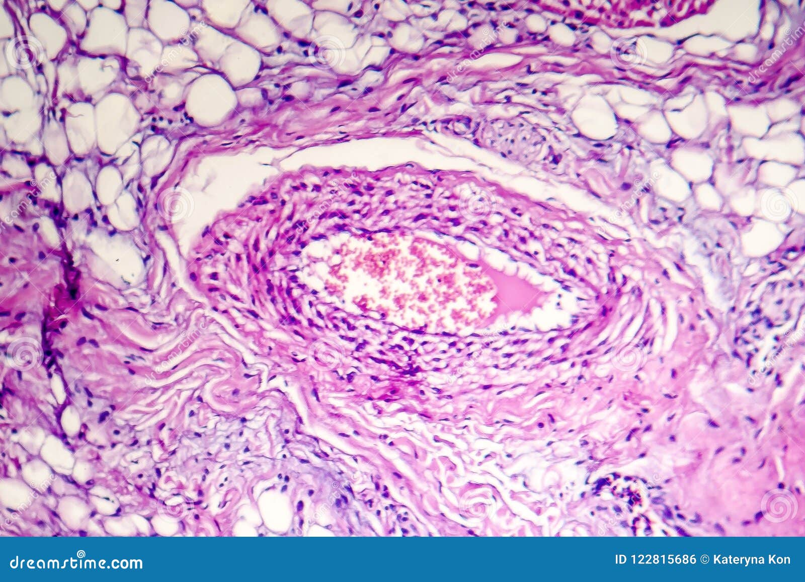 Adipose Tissue Under Microscope View Show Contains Large Lipid Droplet Stock Image