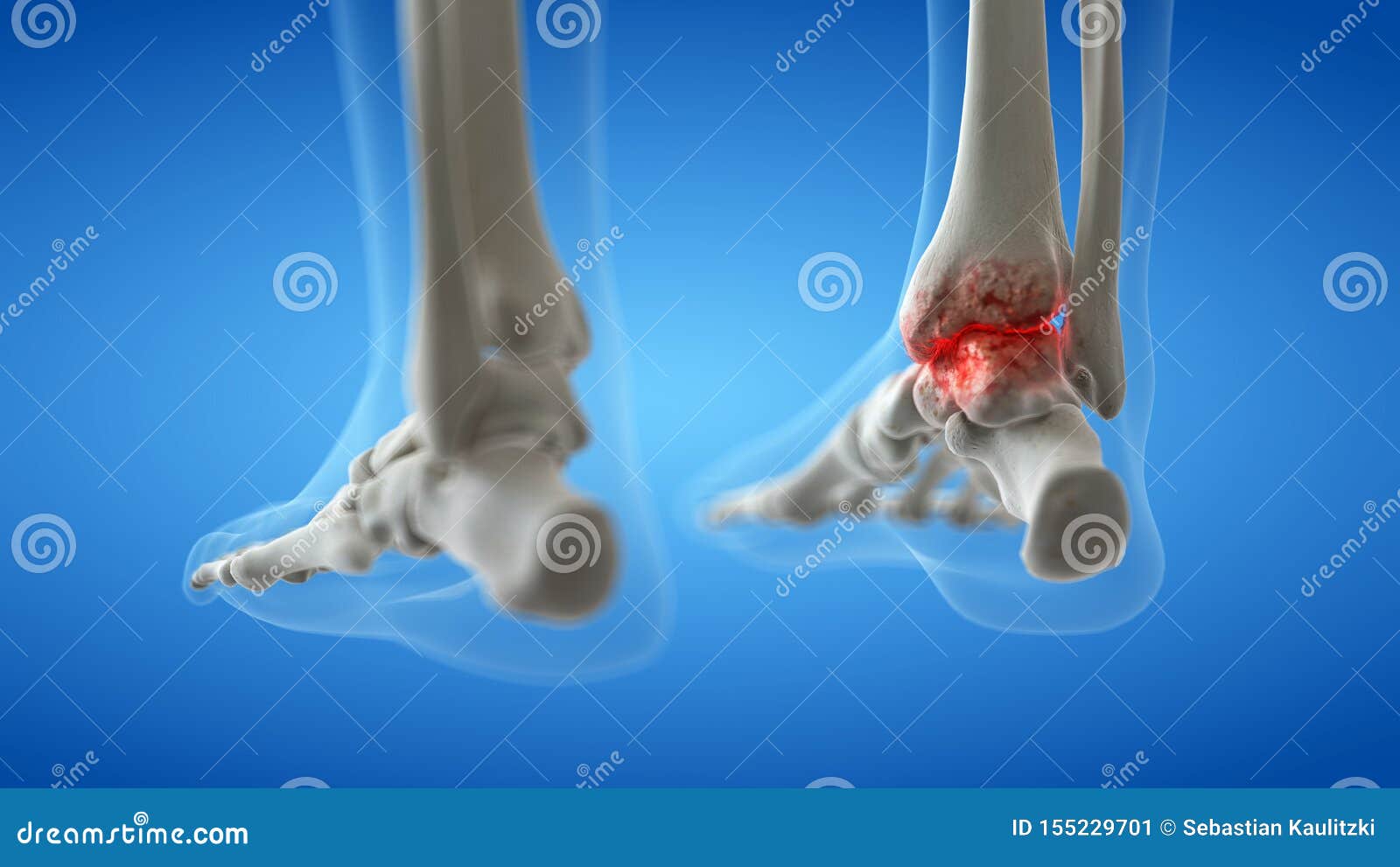An arthritic ankle joint stock illustration. Illustration of healthy ...