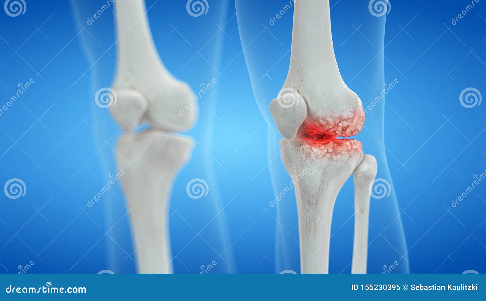 An Arthritic Human Knee Joint Stock Illustration - Illustration of ...