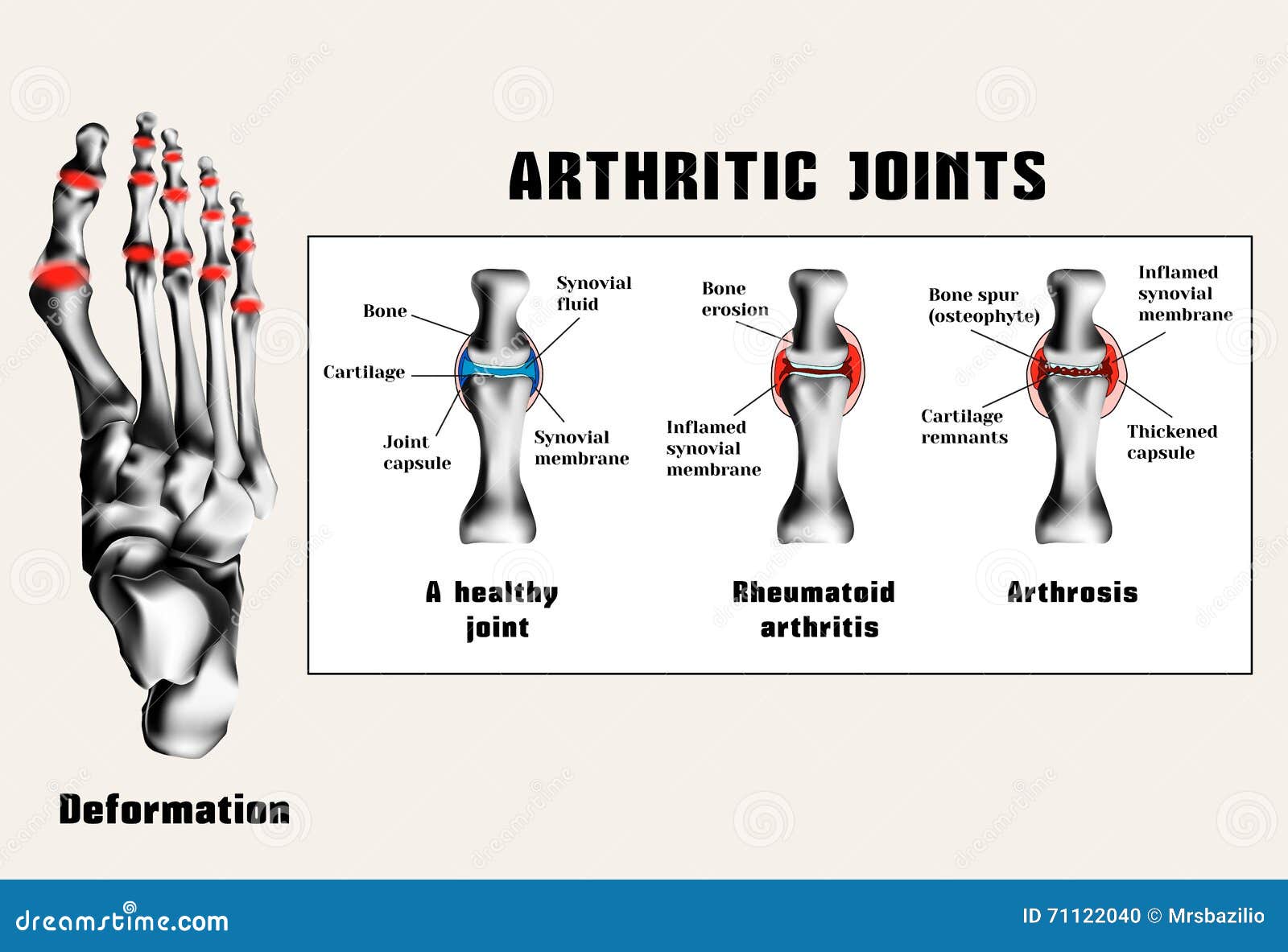 Arthritic Joins Vector Illustration | CartoonDealer.com #71122040