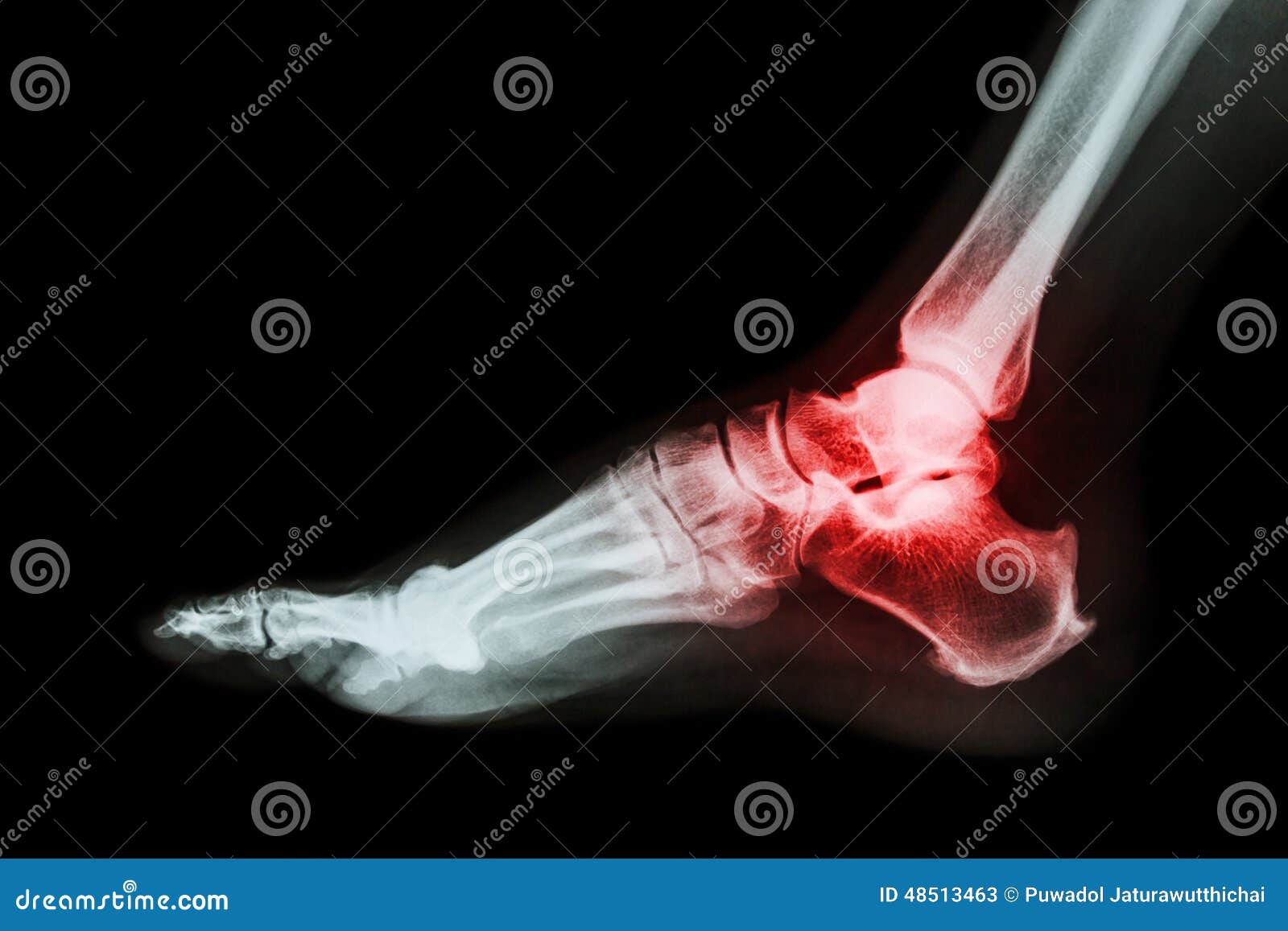 Gout , Rheumatoid Arthritis ( Film X-ray Both Foot And Arthritis At ...